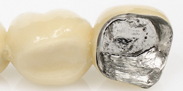 Kronen hochwertig - dent4me